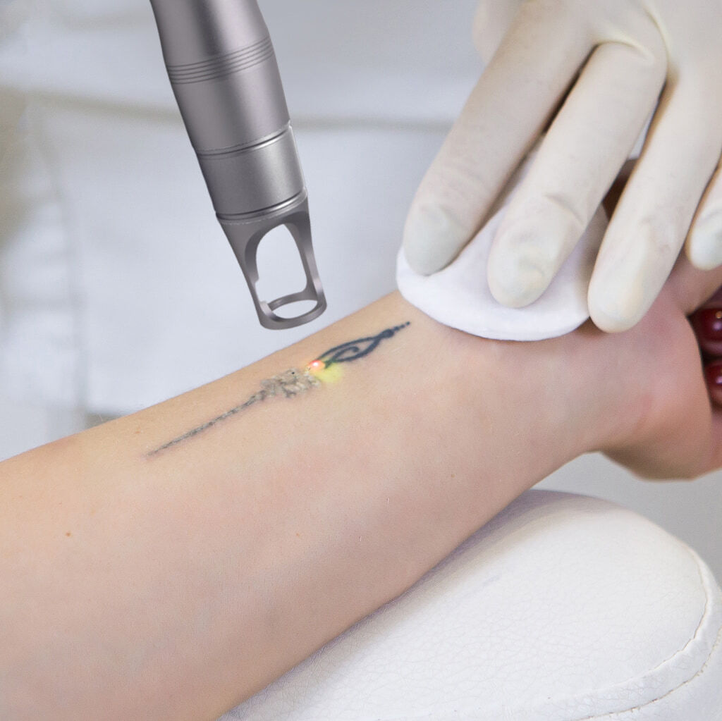 Zemits YAGenix Nd:YAG Laser for Tattoo Removal and Carbon Peeling ...