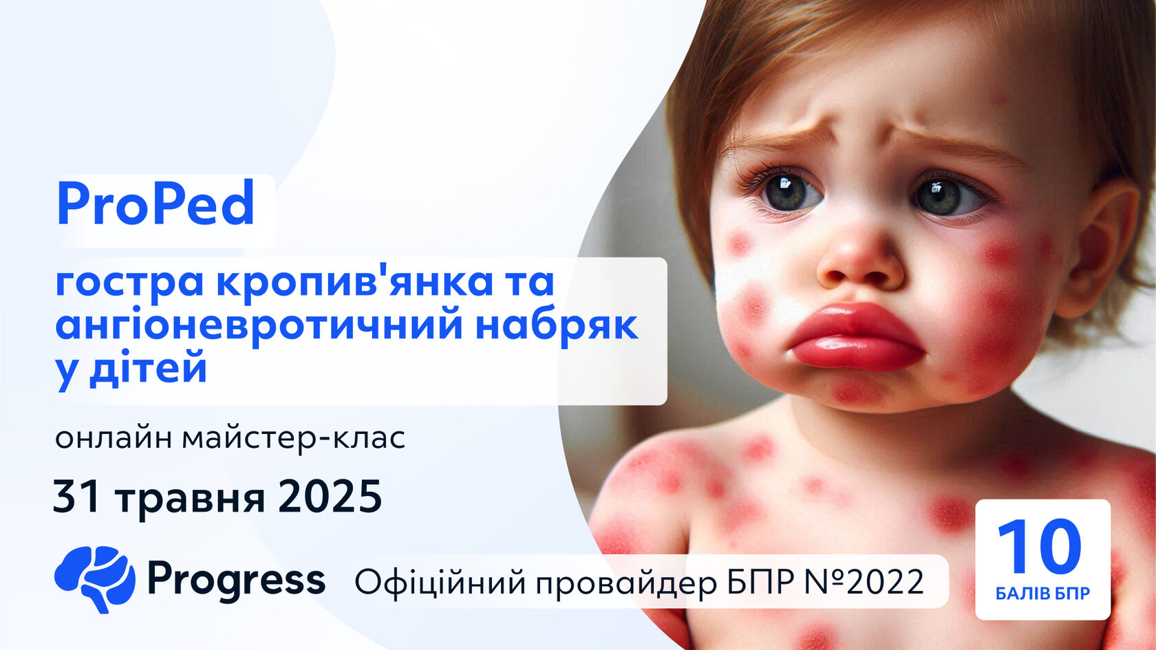 Онлайн майстер-клас ProPed: гостра кропив'янка та ангіоневротичний ...