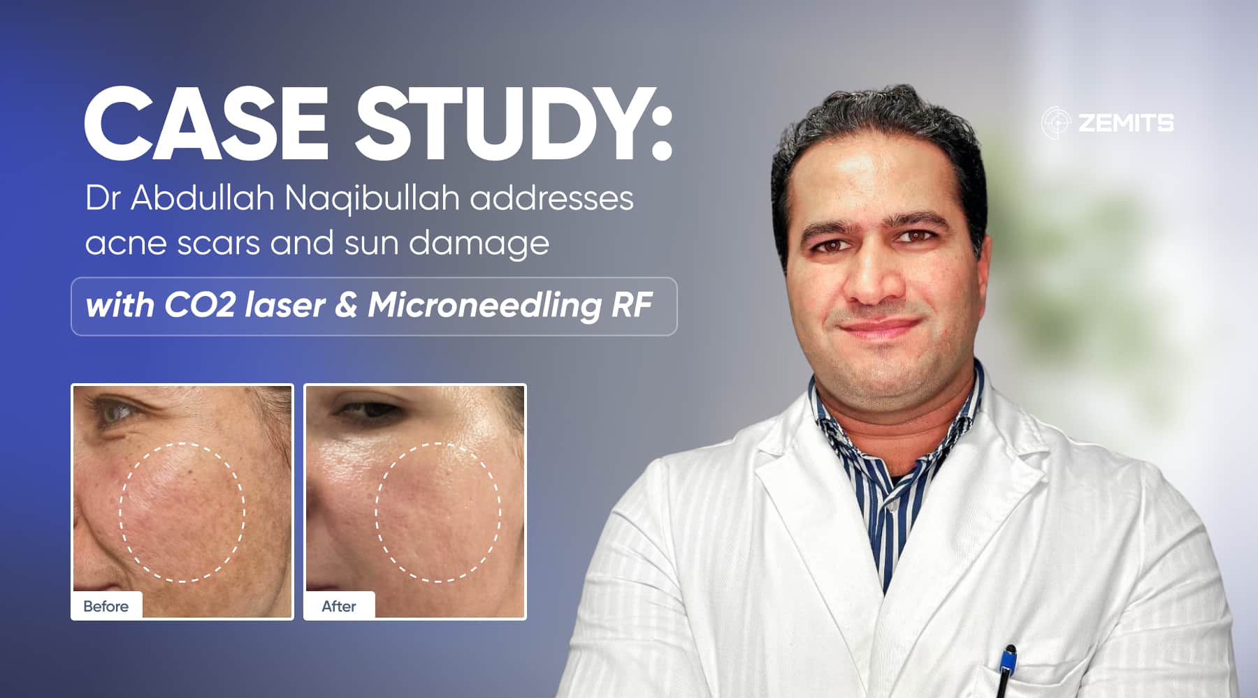 Case study: Dr Abdullah Naqibullah addresses acne scars and sun damage ...