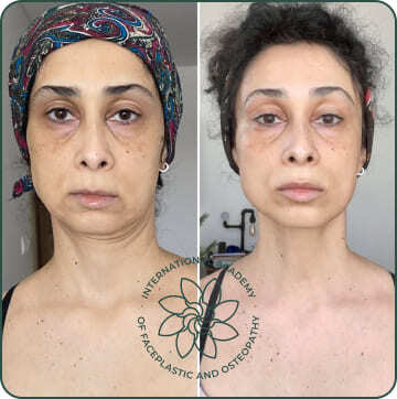 Maxilla — the bone of beauty: