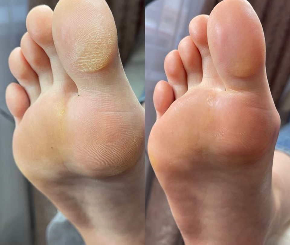 Occhio di pernice cos’è e come rimuoverlo | Nails Secrets