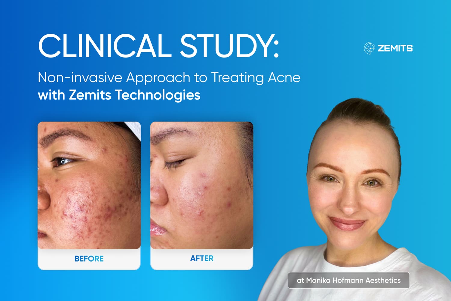 Clinical Study: Non-invasive Approach to Treating Acne with Zemits ...
