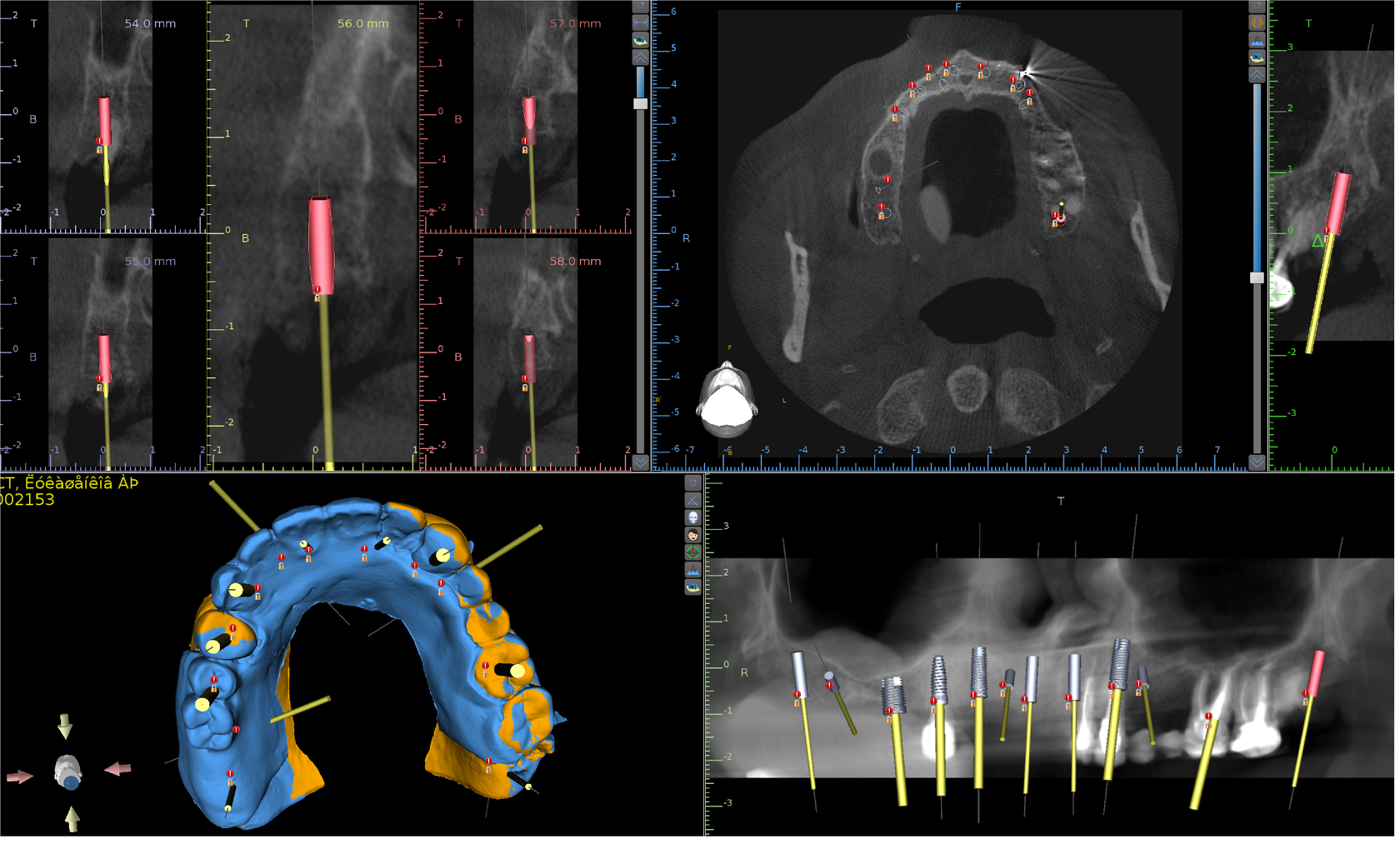 Surgical guides for implantation | 3D planning by FrankoLab