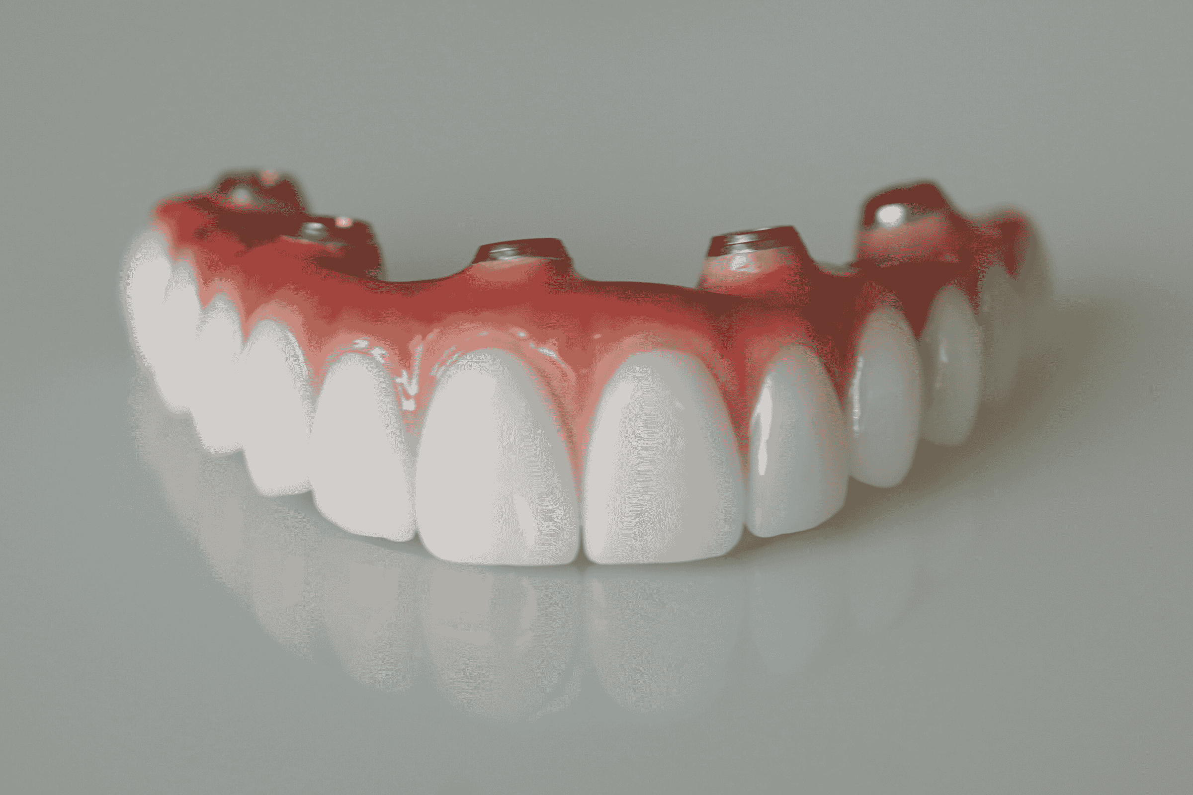 Implant Dentar pentru Toată Gura – Tipuri de Proteze Fixe pe Implanturi ...