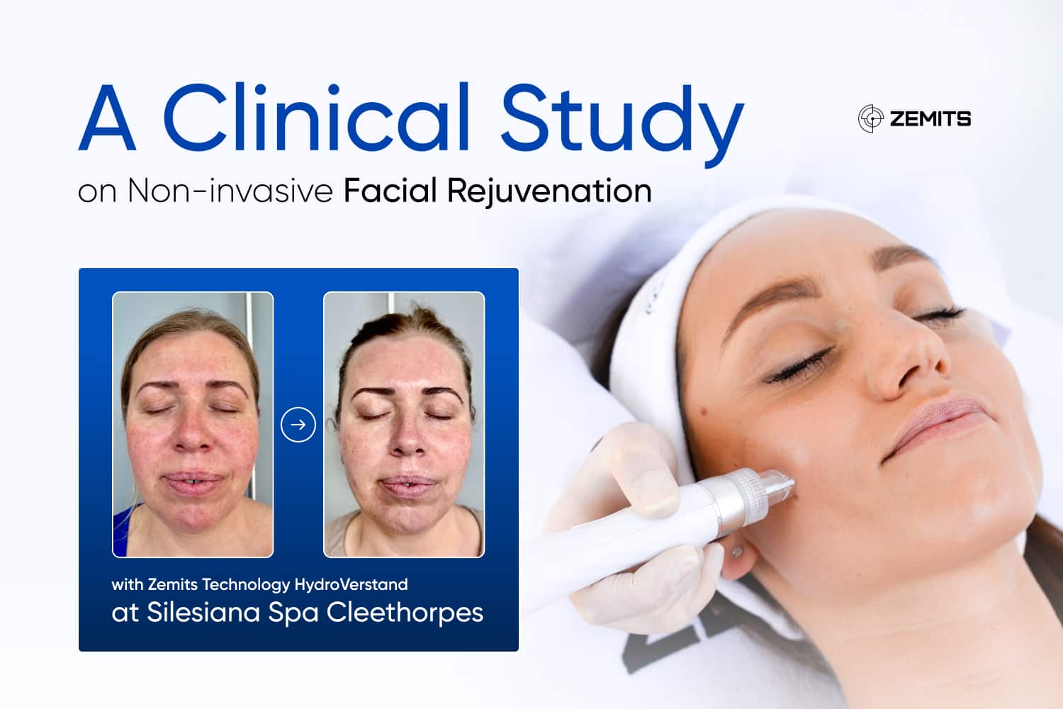 A Clinical Study on Non-invasive Facial Rejuvenation with Zemits ...