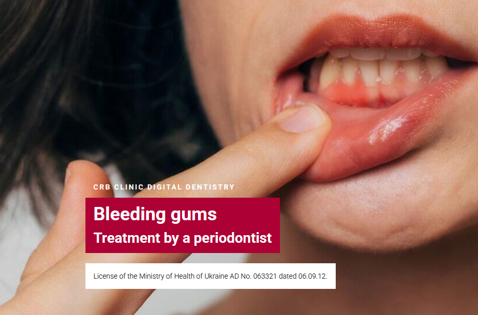 Bleeding gums - diagnosis and treatment by a periodontist