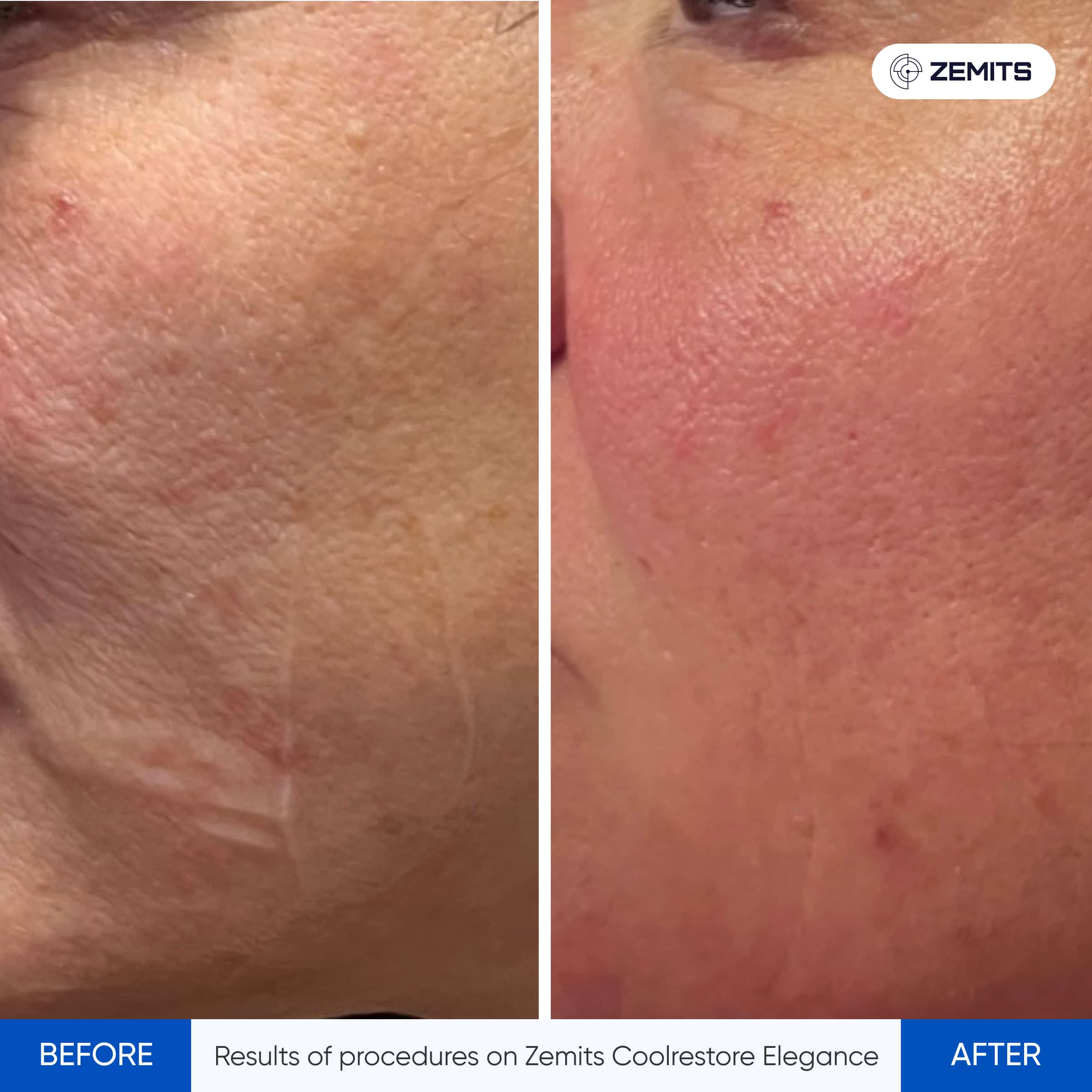 Chill and Thrill: Discover the Magic of Cryo Facials