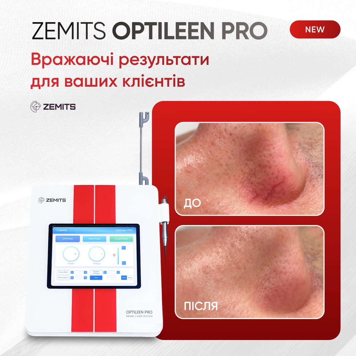 Zemits OptiLeen Pro Діодний лазер 980 нм для видалення судин: Замовити ...