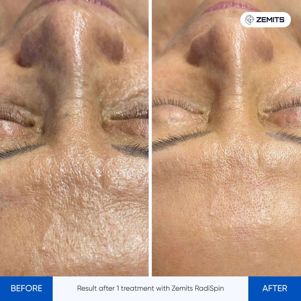 Zemits RadiSpin Portable RF device for professional use|Esthetic Spa ...